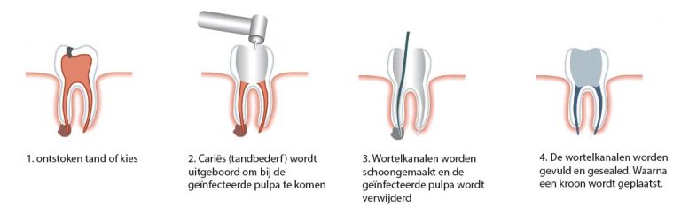 Pulpa | Lees alles over het levend weefsel - DENTAL365